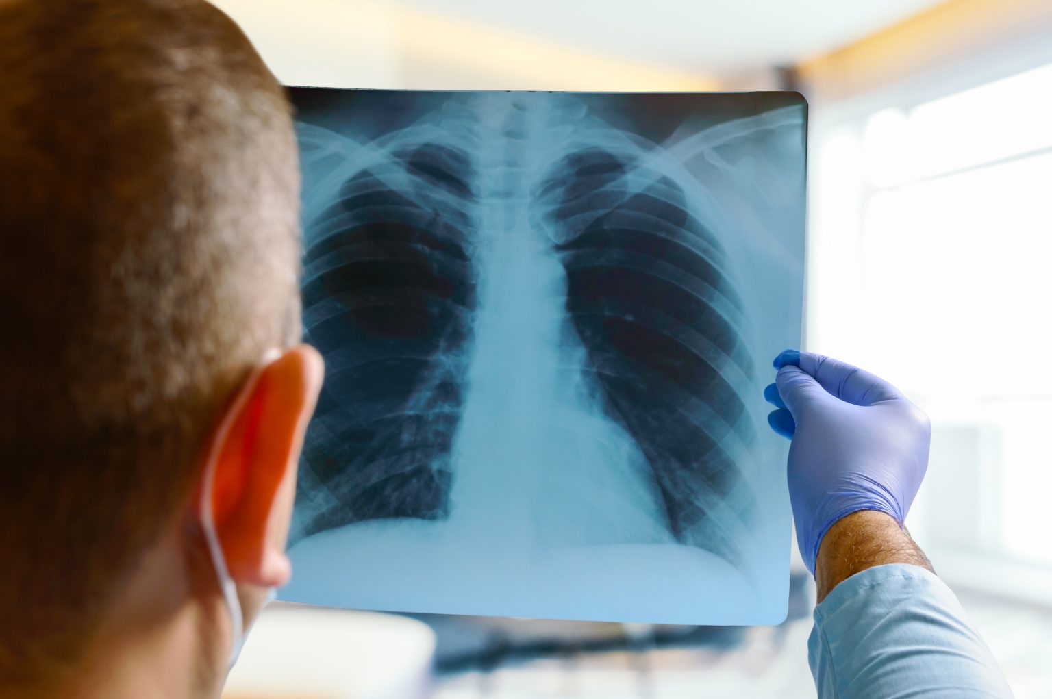 Embolia pulmonara - Simptome, Cauze, Diagnostic și Tratament