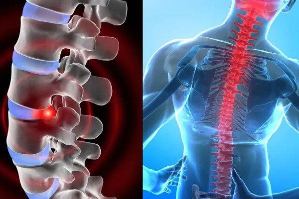 Cifoza ᐈ Simptome, Diagnostic, Tratament ᐈ Clinica Eminescu 100