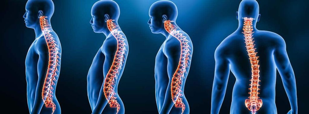 Cifoza ᐈ Simptome, Diagnostic, Tratament ᐈ Clinica Eminescu 100