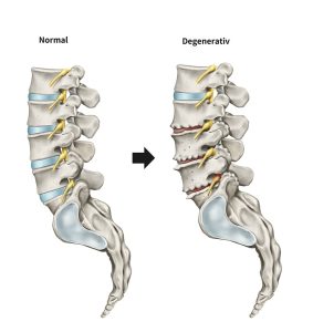 Discopatie Lombara ᐈ Simptome, Diagnostic, Tratament ᐈ Clinica Eminescu 100