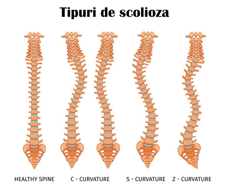 Scolioza: Simptome, Tipuri si Tratament – Clinica Eminescu 100