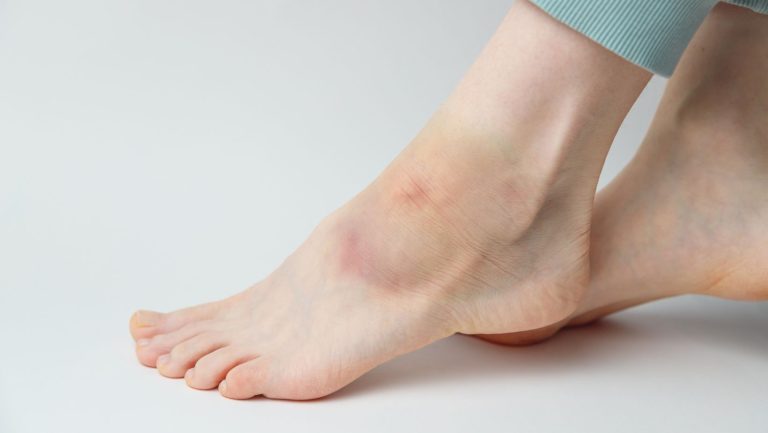 Entorsa: Cauze, simptome si tratament | Clinica Eminescu 100